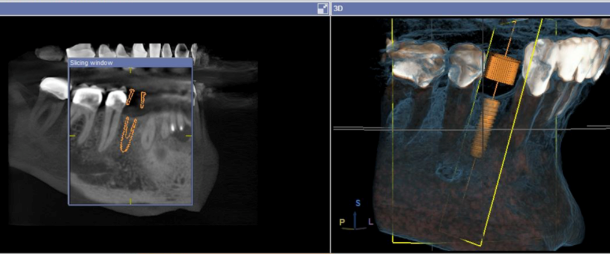 Computer Guided Implant Surgery | BDMS Wellness Clinic