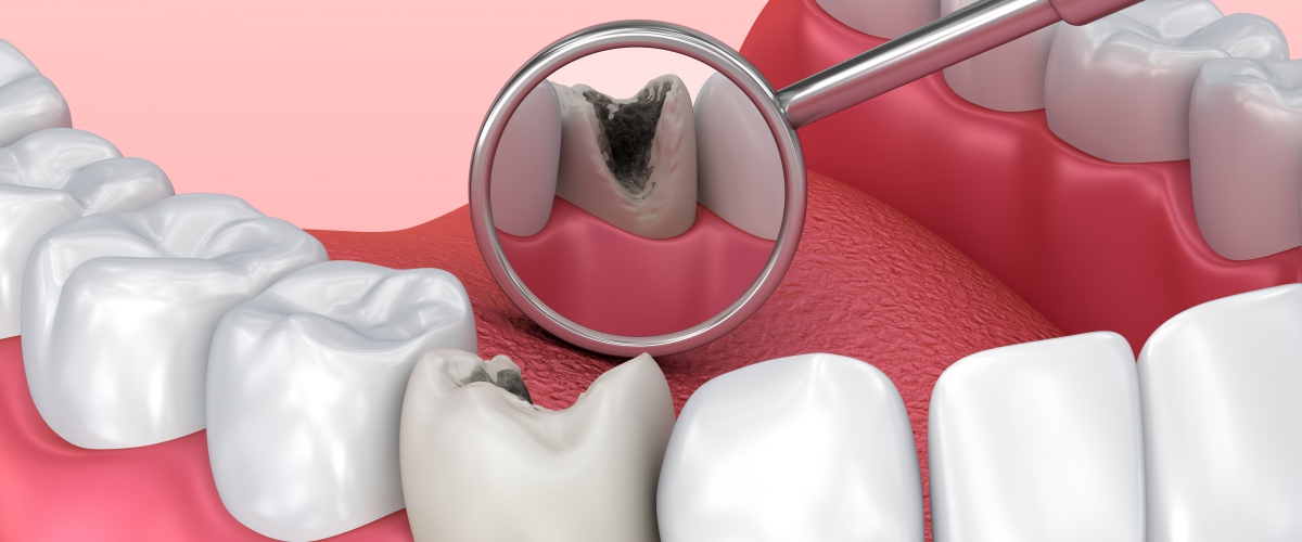 What Is Dental Caries What Is Its Cause at Hamish Gellatly blog